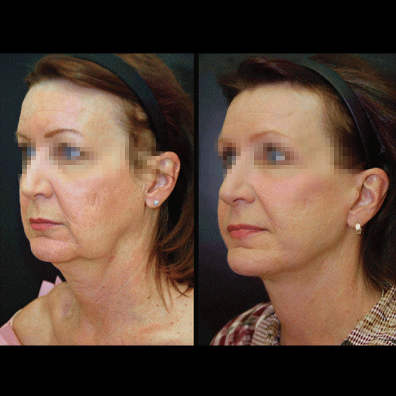 Auro Crosslinked HA 1ml 2ml 10ml Hyaluronic Acid Filler for Face Lip N ...